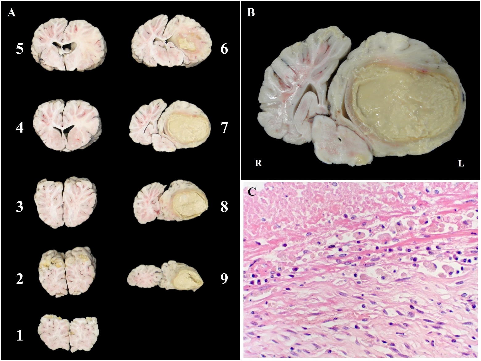 Traumatic brain abscess due to Streptococcus equi subspecies ...